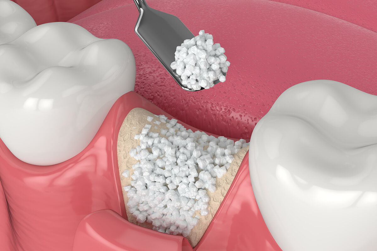 Bone Grafting in Cookstown, ON | Bone Grafting Near Me
