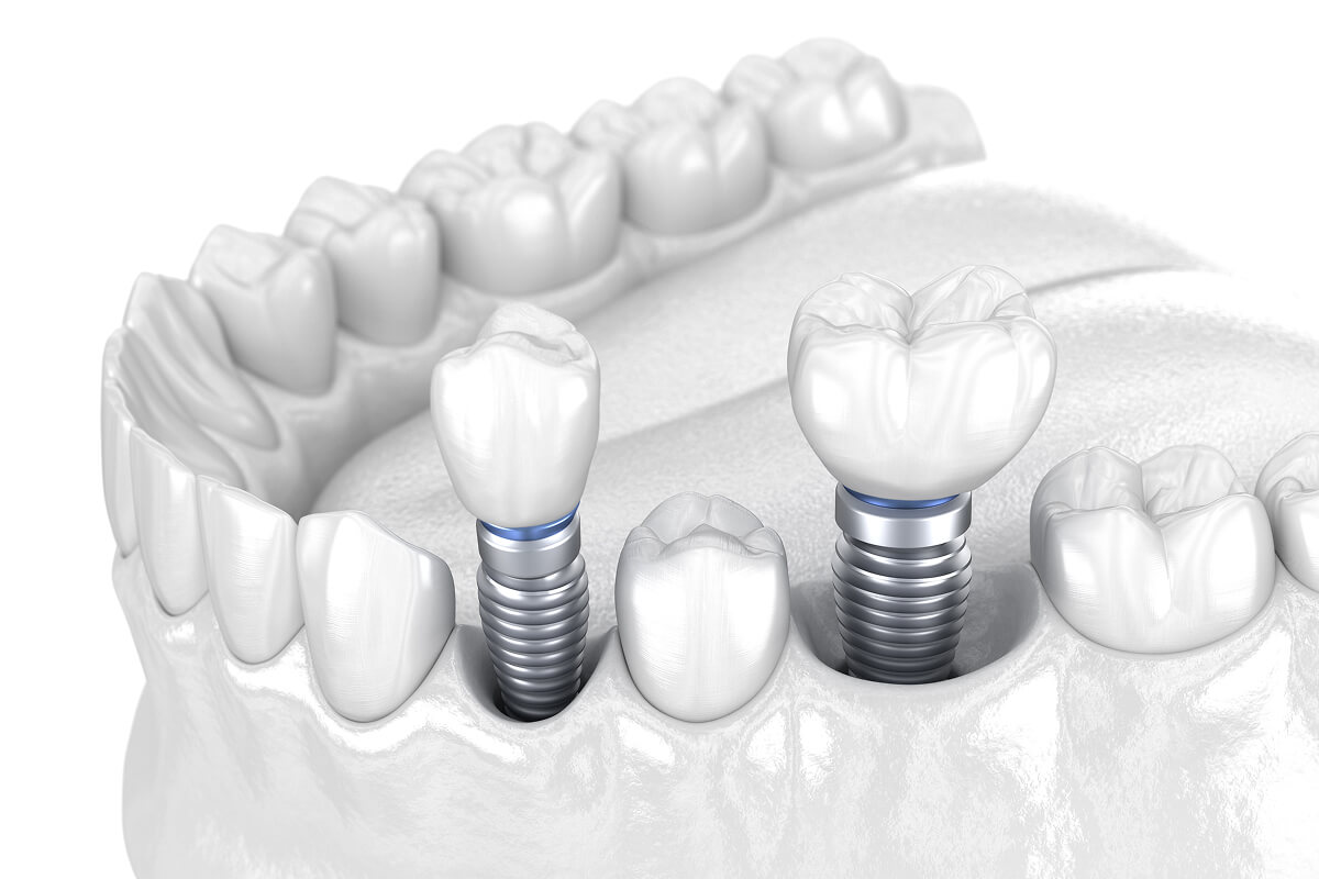 Dental Treatment Options in Cookstown, ON | Implants & More